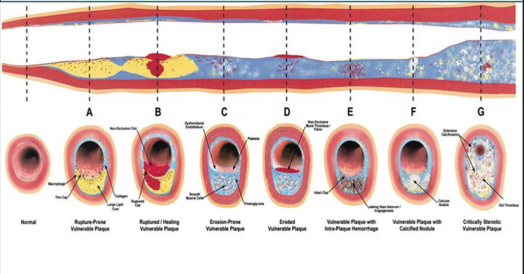Calcium Scoring for Cardiovascular Risk Assessment in the South Asian ...