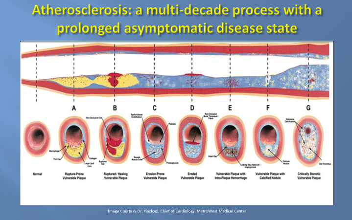 Coronary Calcium Scan – ICC